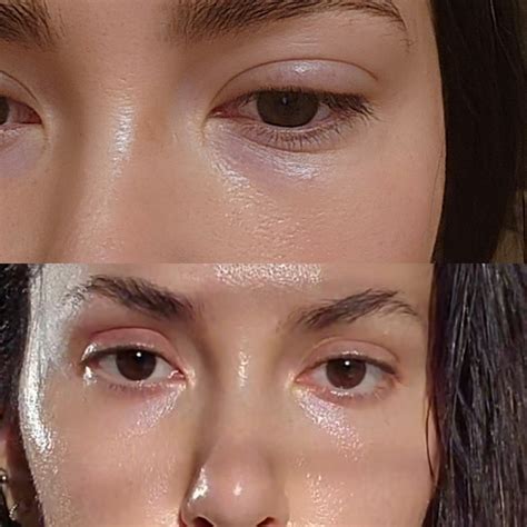 Dissolving My Under Eye Filler A Personal Journey To Lymphatic Health