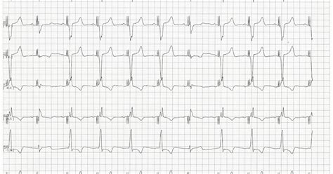 Biventricular Pacing