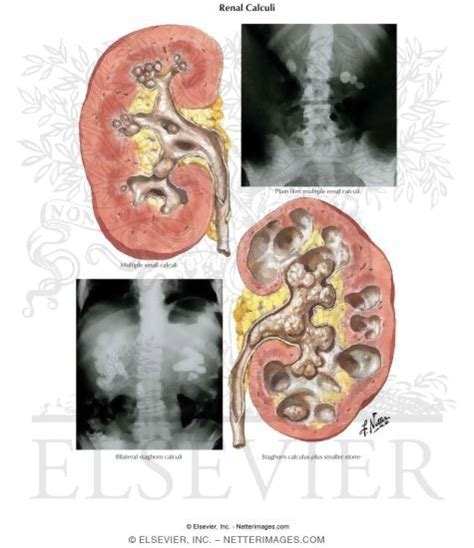 Renal Calculi
