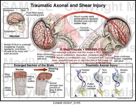 Diffuse Axonal Injury Google Search Injury Traumatic Brain Injury Brain Injury