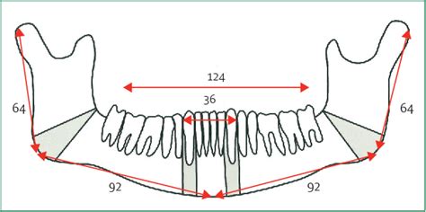 Figure 1 From A New Classification For Mandibular Defects After Oncological Resection