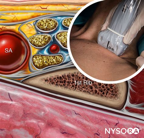 Supraclavicular Nerve Block