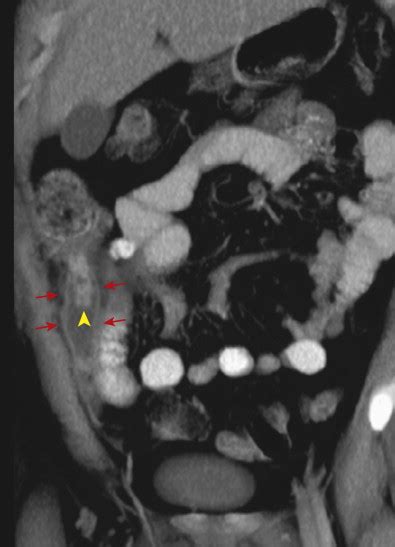 Diseases Of The Appendix Radiology Key