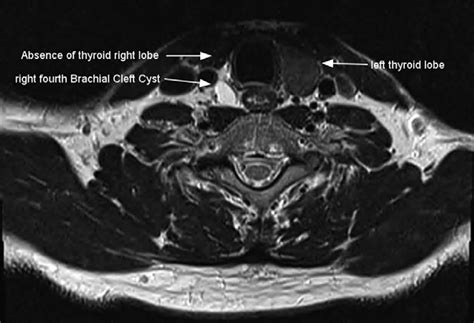 Magnetic Resonance Imaging Cervical Spine With Right Sided