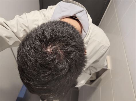 24 Asian Am I Balding Thinning At The Area Above My Crown Or Just