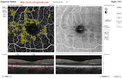 Oct Angiography