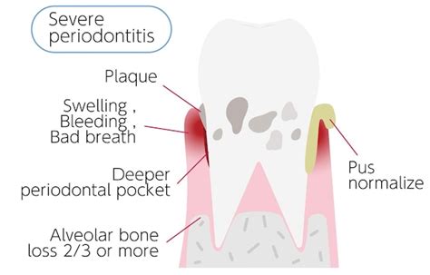Illustratie Per Stadium Van Parodontitis Ernstige Parodontitis Premium Vector