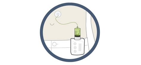 Neuroderms Minipump Passes The Patient Test Fierce Biotech