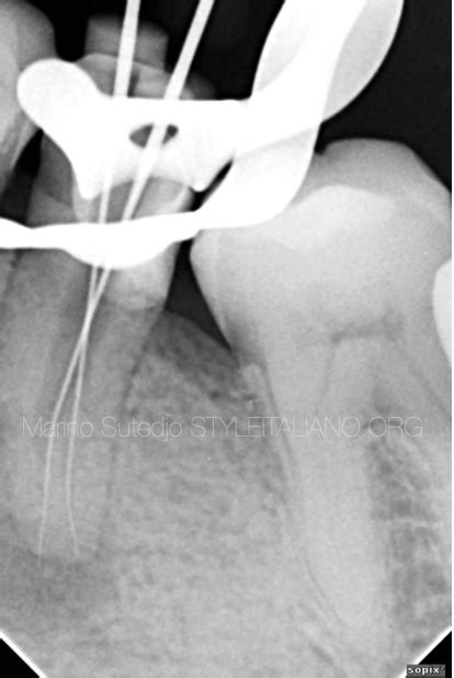 Endodontic Revision On Deep Split Premolar A Case Report Style