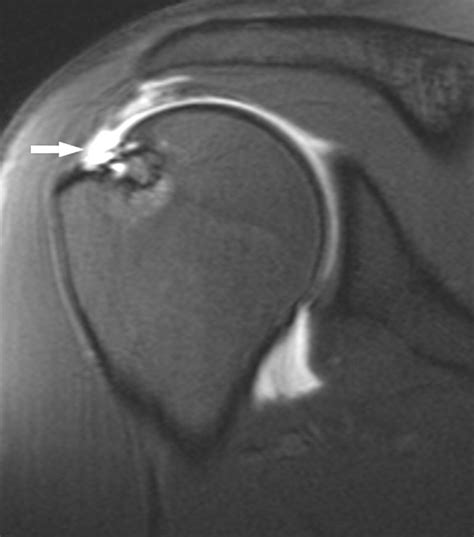 Shoulder Mr Arthrography Which Patient Group Benefits Most Ajr