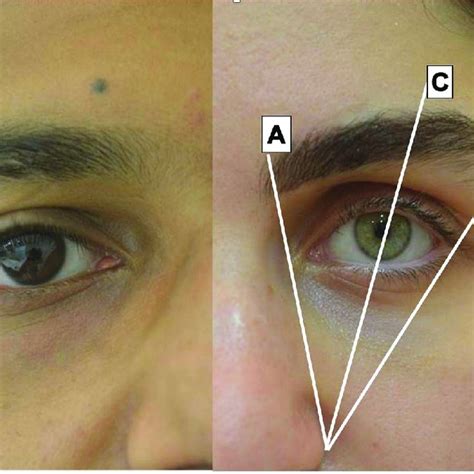Ideal Eyebrow Shapes In Men And Women Notes Adapted From Yalcinkaya Download Scientific