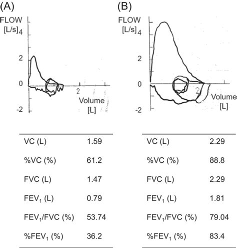 A Pulmonary Function Test Pft Showing Mixed Disorder During Lettuce