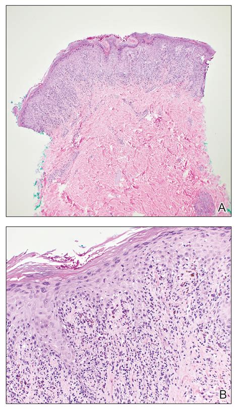 Lichenoid Drug Eruption Secondary To Apalutamide Treatment Mdedge