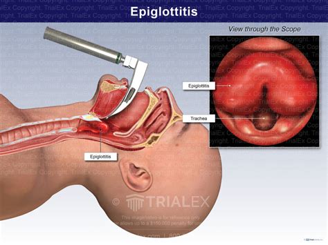 Epiglottis Trialquest Inc