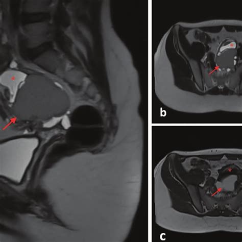 Pre Operative Diagnosis Of The Retrorectal Epidermoid Cyst By Magnetic Download Scientific