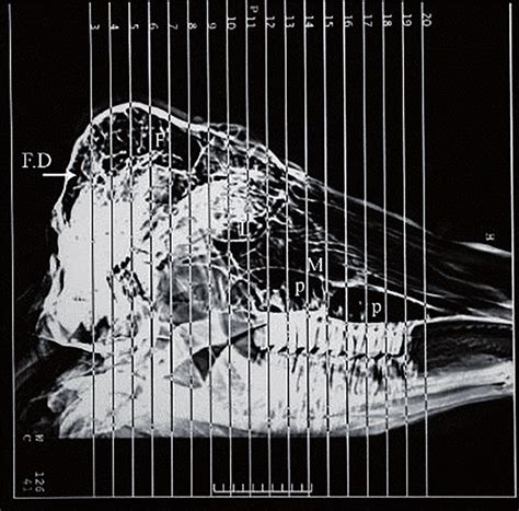Lateral Ct Scan Shows The Levels Of The Section And Paranasal Sinus In