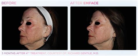Best Non Surgical Facelift Options To Try In 2025 North Shore