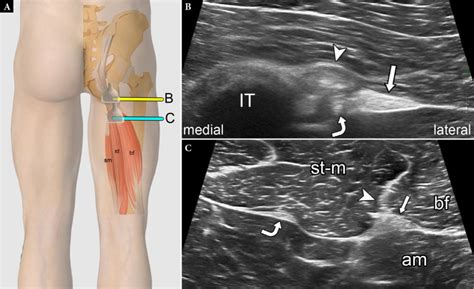 High Resolution Ultrasound In The Evaluation Of The Adult Hip Pmc