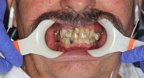 Upper Fixed Implant Bridges Immediate Fixed Temporary Bridge