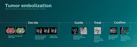 Tumor Embolization Philips