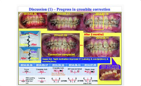 Progress In Crossbite Correction Download Scientific Diagram