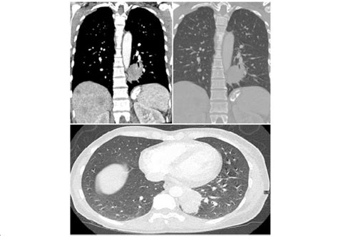 Thorax Computed Tomography Solid Mass With Heterogenic Enhancement