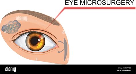 Vector Illustration Of Eyes Microsurgery In Ophthalmology For Medical