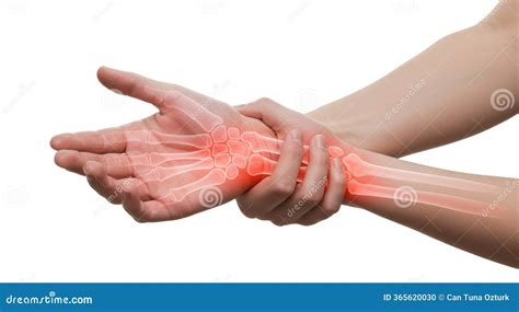 Symptoms Of Bone Fracture Bone Fracture With Displacement Infographics Vector Illustration On