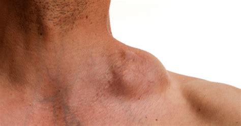 Kanser Limfoma Punca Simptom Dan Rawatan The Diagnosa