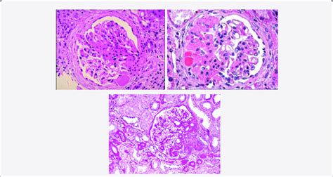 Focal Segmental Hyalinosis After Pathological Analysis Of A Renal