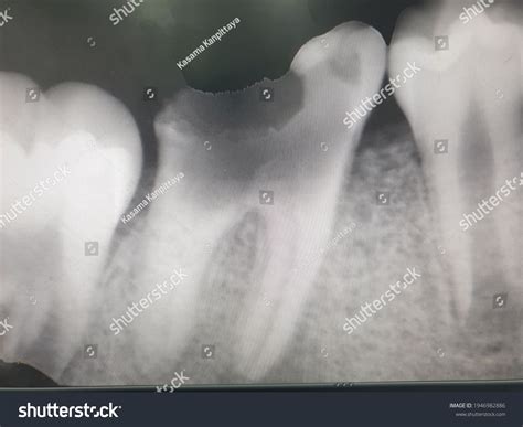 Tooth Cavity Xray