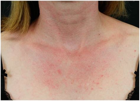 Paraneoplastic Dermatoses A Clue For Underlying Malignancies