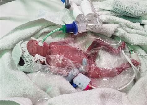 Así Luce La Bebé Que Nació A Los 5 Meses De Embarazo Pesando Medio Kilo Genial