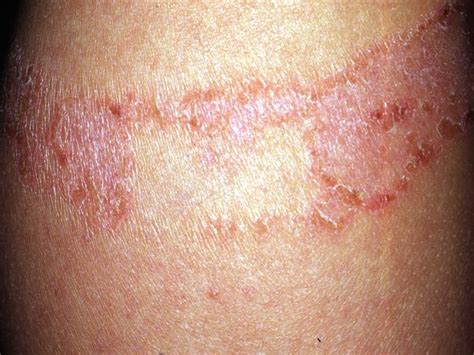 Contact Dermatitis Overview And More