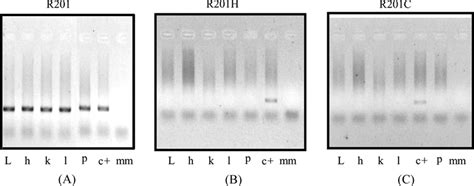 Detection Of R201h Mutation On Gnas1 Gene By Allele Specific Pcr In