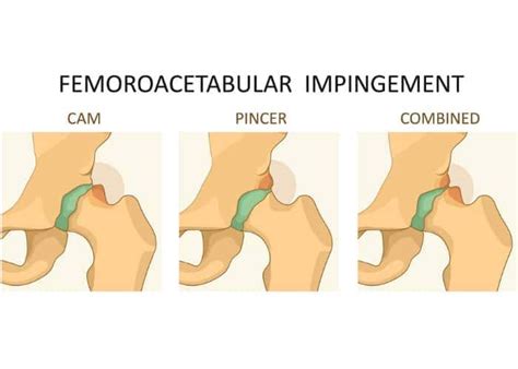 Femoroacetabular Impingement Samarpan Physiotherapy Clinic
