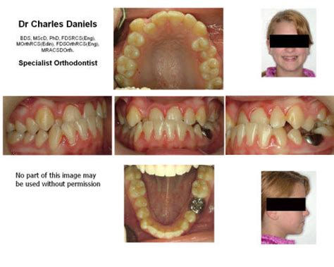 Class 3 Treatment Examples North Sydney Orthodontics Class 3