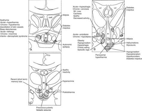 Hypothalamic Syndromes Oncohema Key