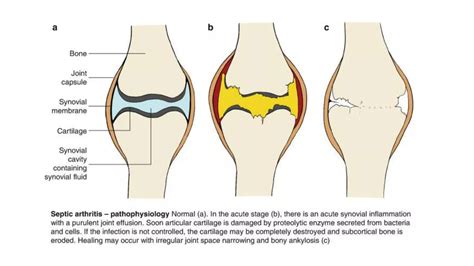 Septic Arthritis 1pptx
