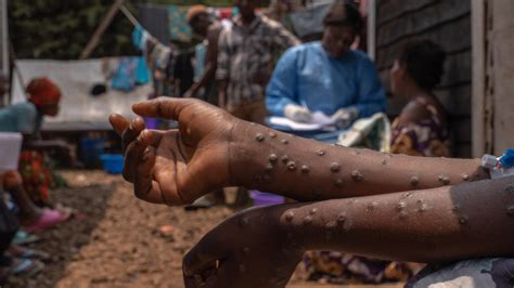 Dr Congo Receives Its First Batch Of Nearly 100 000 Doses Of Mpox