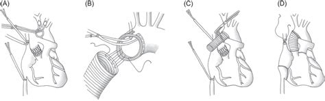 Surgical Stages A Ascending Aorta Resection And Kazui Protocol