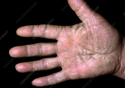 Lichenification In Eczema Stock Image C059 5102 Science Photo Library