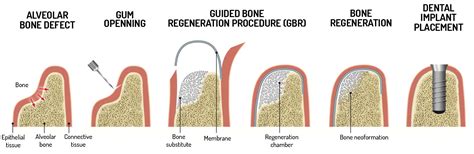 Optimising Bone Regeneration In Dentistry