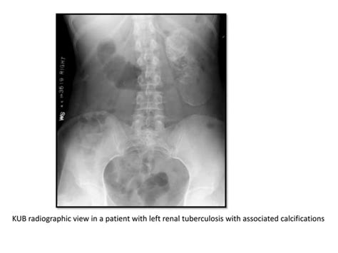 Tuberculosisofurinarytractppt