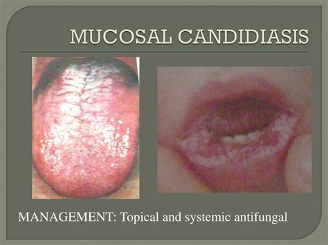 Ppt Fungal Infections In Dermatology Classification Management