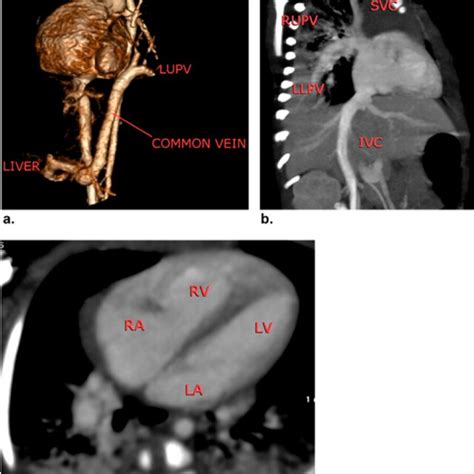 A One Month Old Female Patient With Total Anomalous Pulmonary Venous Download Scientific