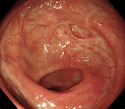 Vasa Recta Diverticulosis