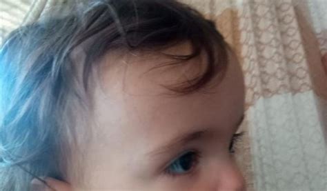 Cirurgia Do Hendrew Silva Escafocefalia Tardia Vaquinhas Online