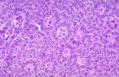 Granulosa Cell Tumor