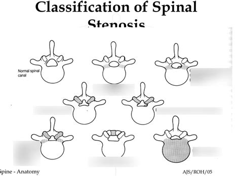 Diagram Of Mjm Week 6 Classification Of Spinal Stenosis Quizlet